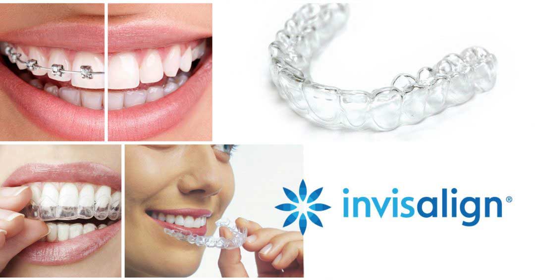 Top 10 Best Invisalign Clinics in Malaysia 2025 | Visit Now